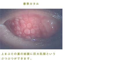 結膜疾患 うぐいす眼科宝塚市の眼科 日帰り白内障手術