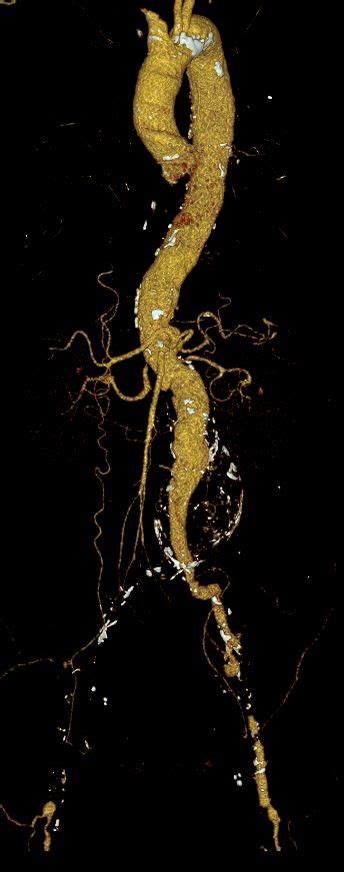 Ahmed Koshty Md On Linkedin Sympatomatic Taaa Type Iv In A Female Patient With Occlusion Of The