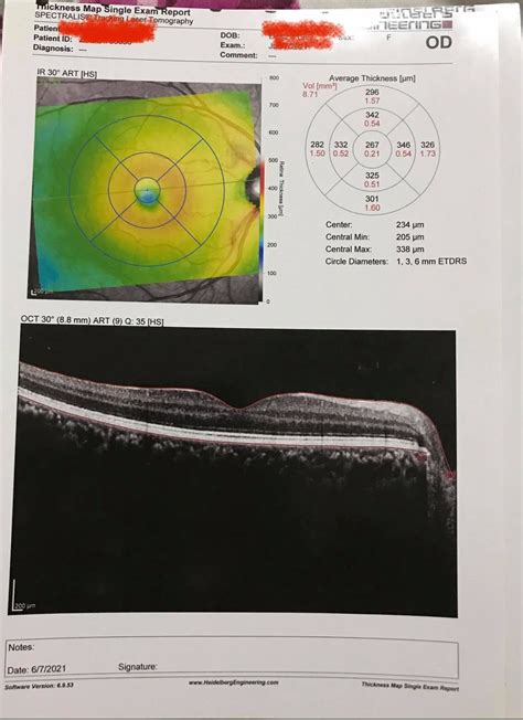 Oct Scan Roptometry