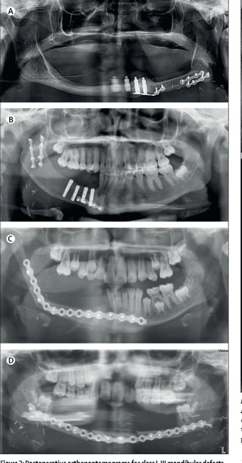 Figure 2 From A New Classification For Mandibular Defects After