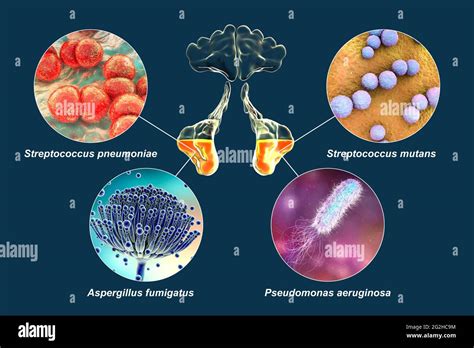 Streptococcus Mutans