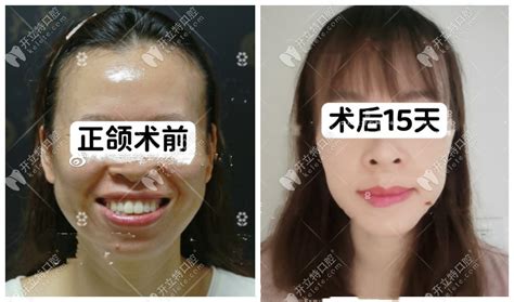 龅牙怎么改善 门牙 大山谷图库