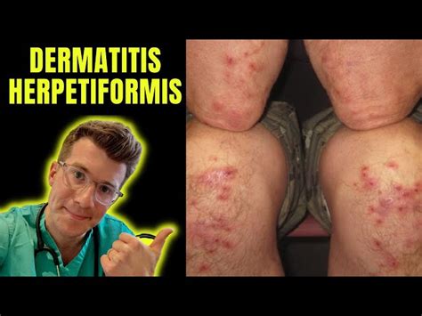 Mild Dermatitis Herpetiformis Dermatitis Herpetiformis Fotos Und