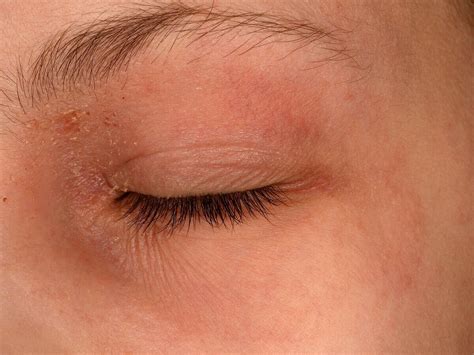 What Is Eyelid Dermatitis Eyelid Eczema 47 Off