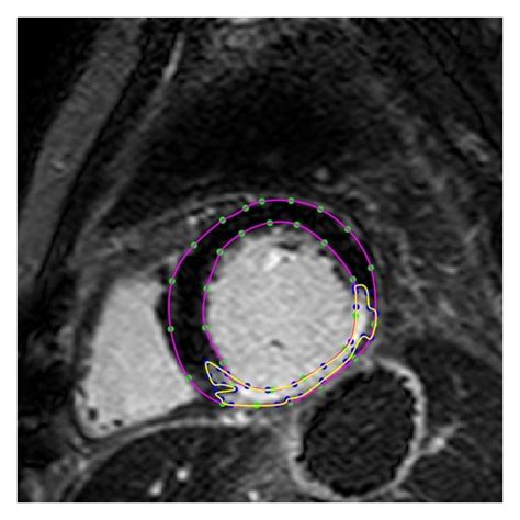 Cropped Short Axis Cmr Image Showing Manual Segmentation Of Myocardium