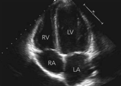 Subxiphoid Ultrasound