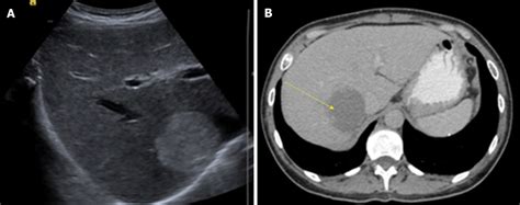 What Is A Hepatic Mri At Douglas Jacobson Blog