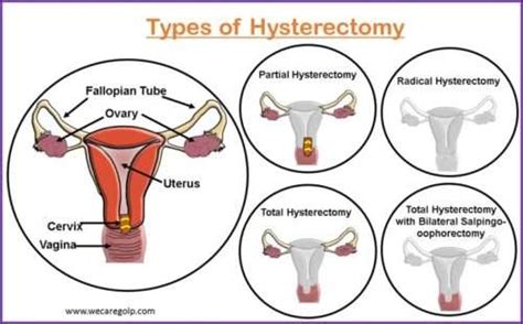 Hysterectomy Types Procedures Complications We Care