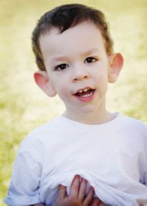 Signs And Symptoms Of Fragile X Syndrome Autistic Advisor