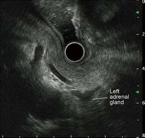 Standard Imaging Methods In The Pancreatobiliary Region Using Radial Eus Olympus Professional