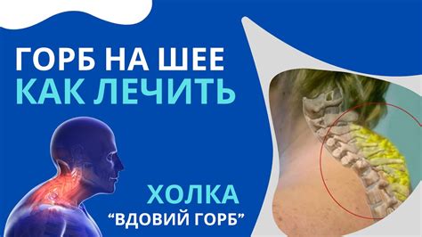 Горб на шее «Вдовий горб Причины и лечение Методы безопасного избавления от холки на шее