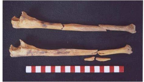 1 Perimortem Fractures Of The Left And Right Ulnae Of Body