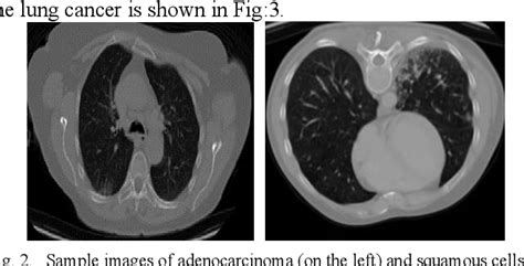 Figure 2 From Lung Cancer Detection Using Transfer Learning And Efficientnet B2 Architecture