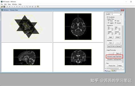Diffusion Spectrum Imaging Dsi 扩散光谱成像 与 Diffision Tensor Imaging （dti）弥散张量成像的优劣？ 知乎