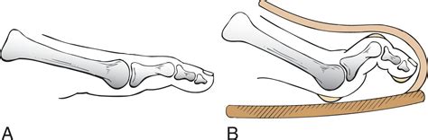 Lesser Toe Deformities Clinical Tree Lesser Toe Deformities Clinical Tree
