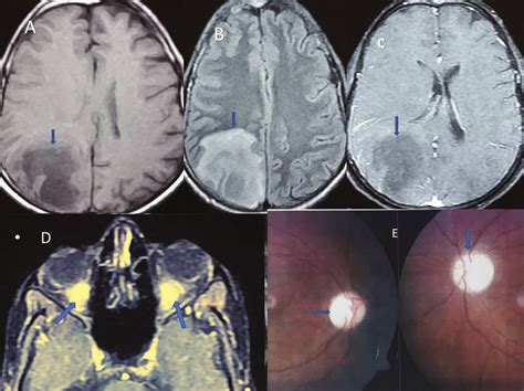 Magnetic Resonance Imaging Of The Cranium A Heterogeneous Lesion In Download Scientific