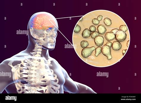 Cryptococcus Infection