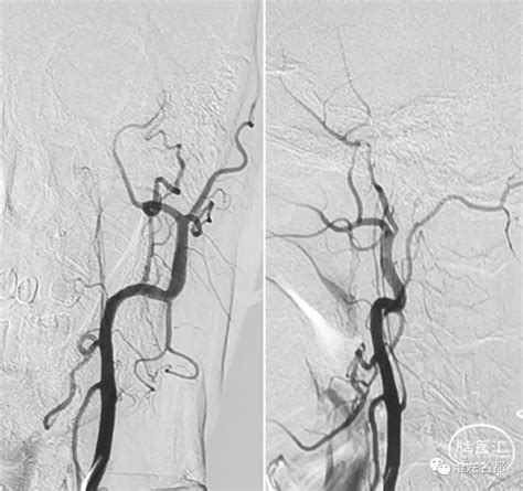 影像读片（47）：颈内动脉未发育（先天缺如）的dsa Ct 管壁mri诊断表现 脑医汇