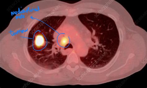 NURS3600 Diagnostic Tests Flashcards Quizlet