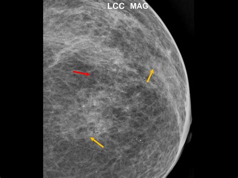 Atlas Of Breast Cancer Early Detection