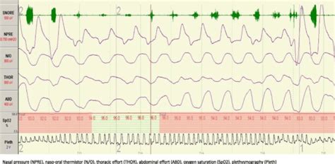 Apnea Hypopnea And Sleep Fragmentation Optimal Sleep Airway Health