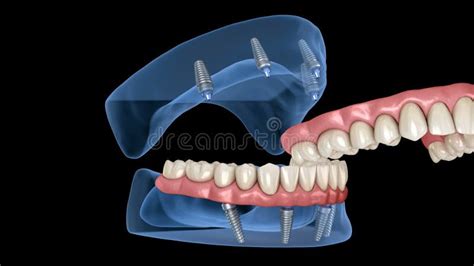 Mandibular Prosthesis All On 4 System Supported By Implants Medically Accurate 3d Animation Of