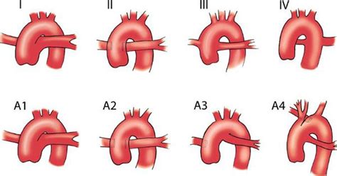 Truncus Arteriosus Thoracic Key