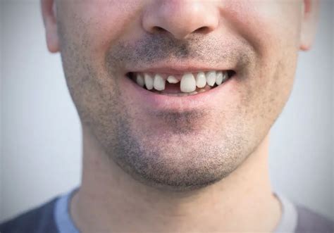 Can A Dentist Fix Damaged Teeth Dental Procedures