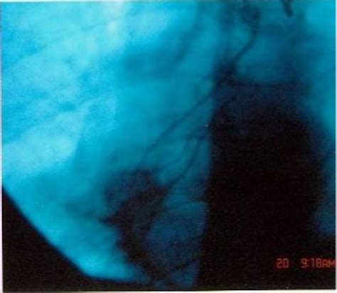 Studies On Lung Cancer Angiogenesis Application Of Interventional