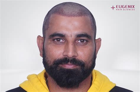 Mohammed Shami Norwood Class 5v Hair Transplant Results And Hair