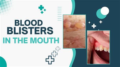 Blood Blisters In The Mouth Youtube