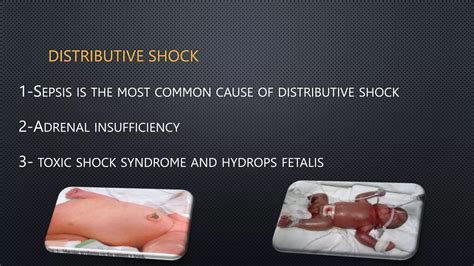 Neonatal Shock Management Autosaved Pptx