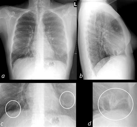 Lungs Fx Thin Walled Cysts Of Varying Sizes With A Diffuse Bilateral Distribution Dx