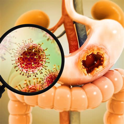 What Patients With Gist Should Know About Their Disease What Patients With Gist Should Know About Their Disease