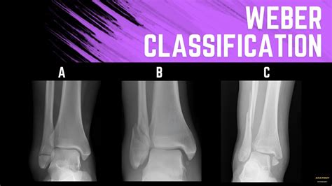 Weber Classification Ankle Fractures Youtube
