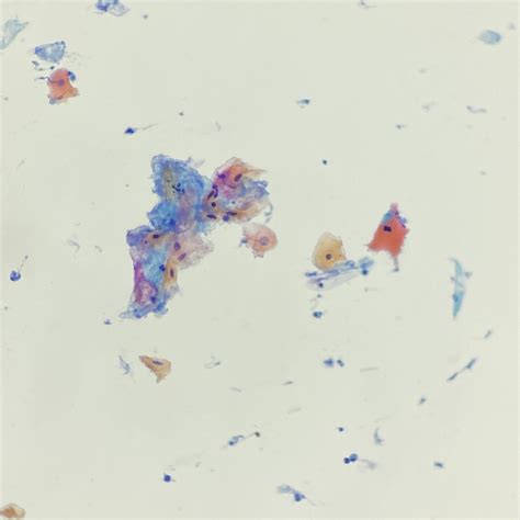 Lymph Node Fna Hx Of Sqcc R Cytopathology