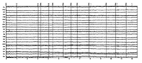 Dynamic Brain Network Node Consistent Behavior Analysis Method Based On Electroencephalogram