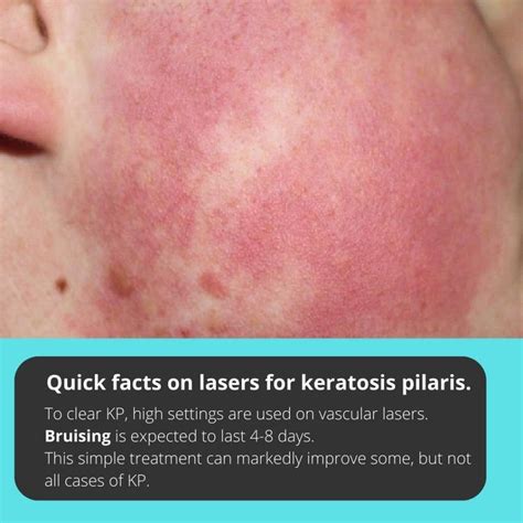 Dr Bronners Keratosis Pilaris At Maria Elsberry Blog