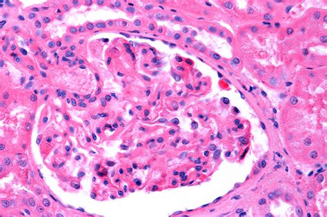 Expert Perspectives Complement Cascade Dysregulation In Primary