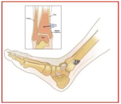 Proximal Tibia Io