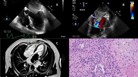 A Case Of Metastatic Intimal Sarcoma Presentation Diagnosis And Management Jacc