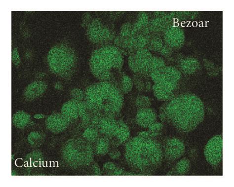 Electron Microscopy Images The Cut Surface Of The Bezoar Showed
