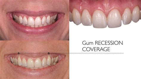 Gum Grafts Dental Implants Glenview Il Glen Perio Dr Joshua Hassan