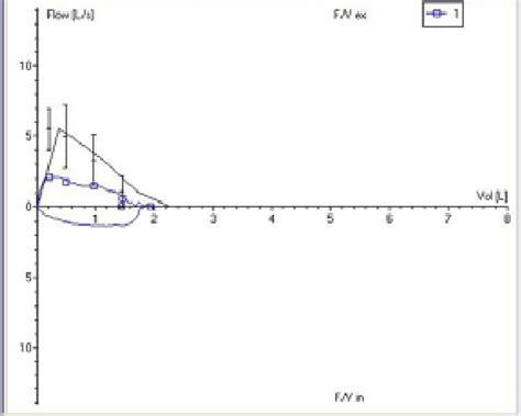 Flow Volume Loop Of Patient With Laryngeal Rheumatoid Arthritis Where