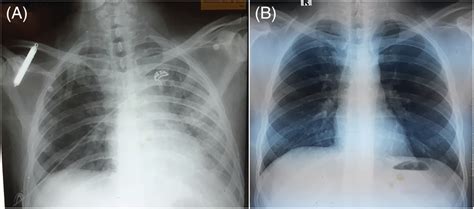 A Chest X‐ray Cxr Done On Admission Showing Left‐sided