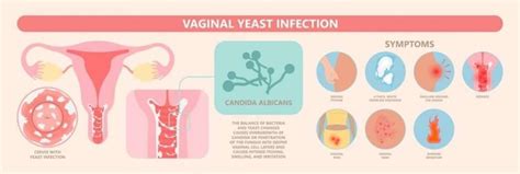 How Long To Wait For Sex After Yeast Infection