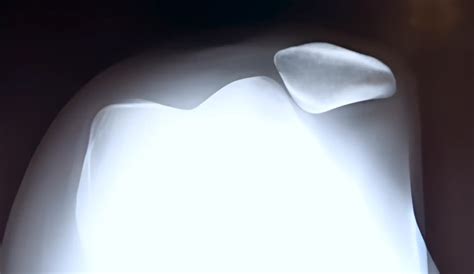 Patella Dislocation Dr Bradley Seeto