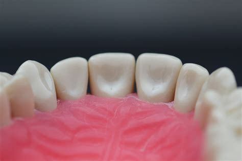 Introduction To Incisor Crown Preparation International Dentist Central