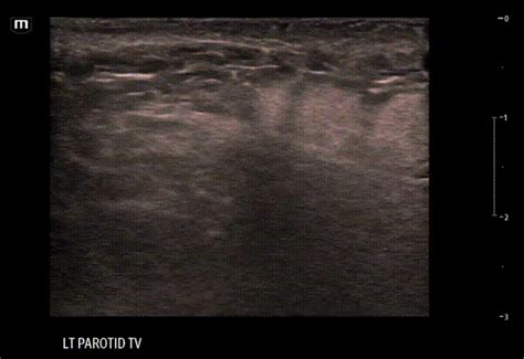 Case 33 Parotid Mass Ucsd Ultrasound