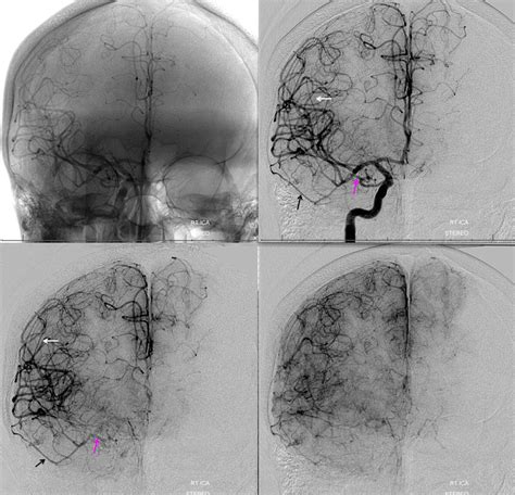 Middle Meningeal Artery
